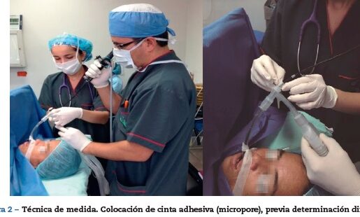 Descubre la posición corporal óptima para una intubación endotraqueal ...